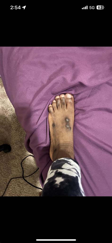 Any Advice For Getting Rid Of These Bug Bite Scars Rskincareaddicts