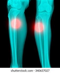 Proximal Tibia Fracture Images Stock Photos Vectors Shutterstock