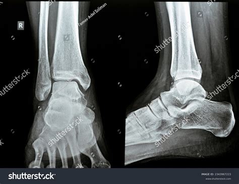 Distal Tibiofibular Joint X Ray