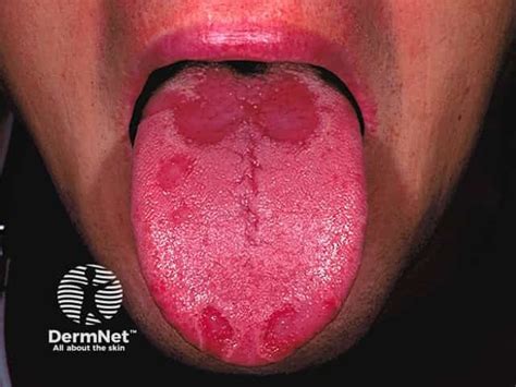 Erythema Migrans Tongue Geographic Tongue Benign Migratory Glossitis