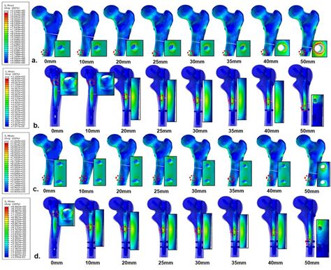 Stress Distribution Around The Cortical Bone And Implant Of Finite