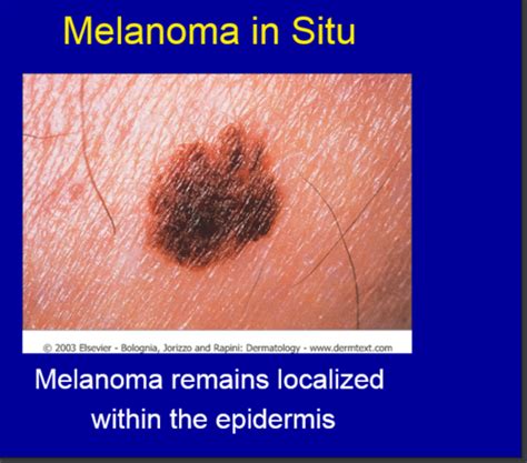 Fam Med Case 13 Skin Lesions Flashcards Quizlet