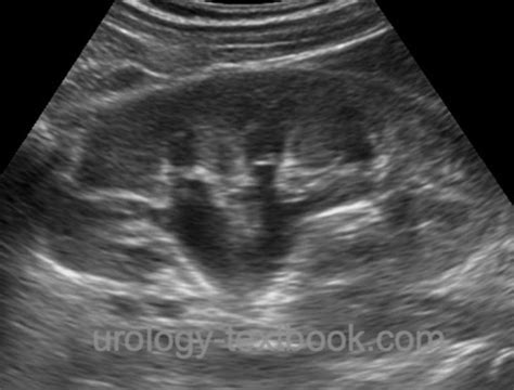 Ureter Ultrasound Sonography Of Hydronephrosis