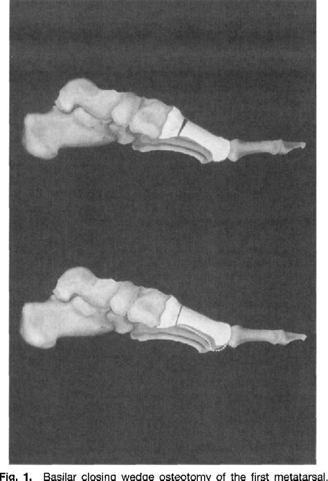 Figure 1 From Dorsiflexion Metatarsal Osteotomy For Treatment Of