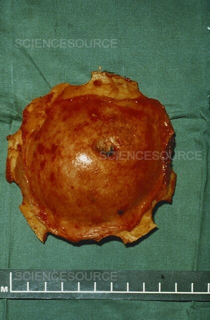 Parietal Craniotomy On Meningioma Tumo Stock Image Science Source