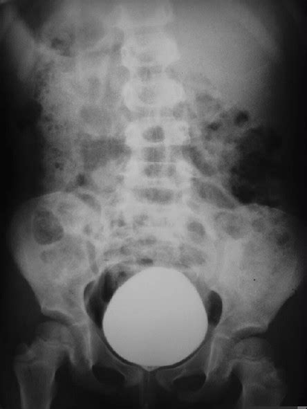 Voiding Cystourethrography Shows No Vesicoureteral Refl Open I