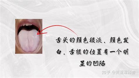 肾虚不虚舌象告诉你一分钟教会你分辨阴虚阳虚阴阳两虚 知乎