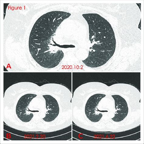 A Bronchoscopy Revealed That The Bronchial Mucosa On Both Sides Was