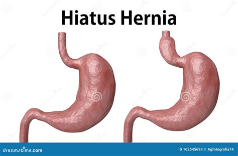 Hiatal Hernia Vector Diagram Of Normal Anatomy And Sliding Hiatal Hernia