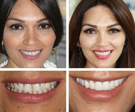 Composite Bonding And Veneers Central London W1 Uk Harley Street