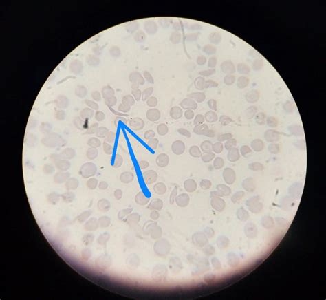 Mehdi A Farahani On Linkedin Sickle Cell Hb Electrophoresis Is