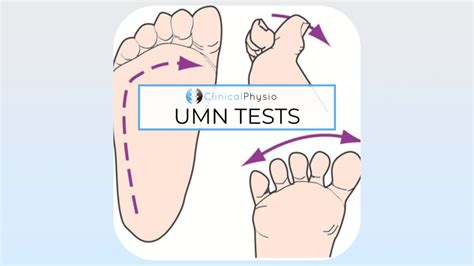 Inverted Supinator Sign Clinical Physio Membership