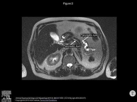 High Prevalence Of Pancreatic Cysts Detected By Screening Magnetic