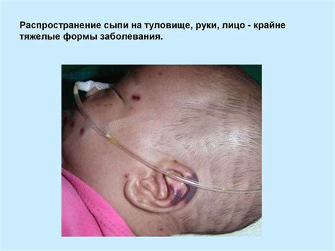 Менингококковая инфекция у детей презентация онлайн