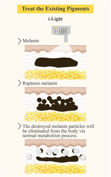 Skin Pigmentation Johor Bahru Pigmentation Johor Bahru Idos