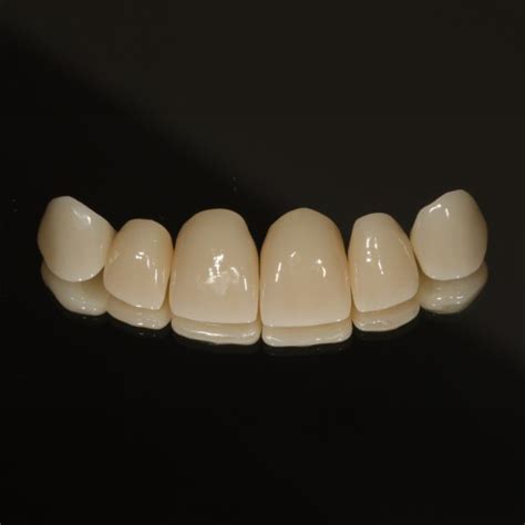 Veneers Behandlung in Ingolstadt: Zahnästhetik | Dr. Vogtner