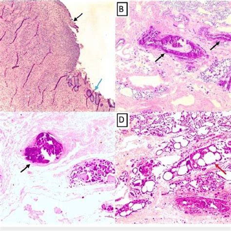 Histopathology Findings On H E Stain Of The Resected Colon A