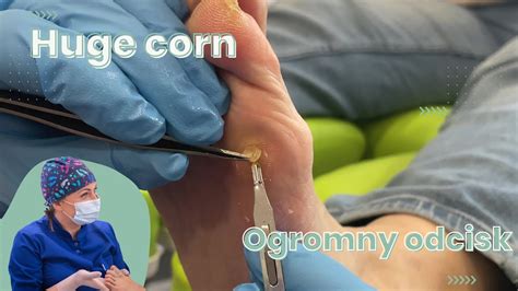 Huge Corn Ogromny Odcisk Youtube