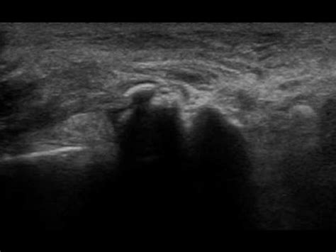 Calcaneal Anterior Process Fracture Ultrasound Cases