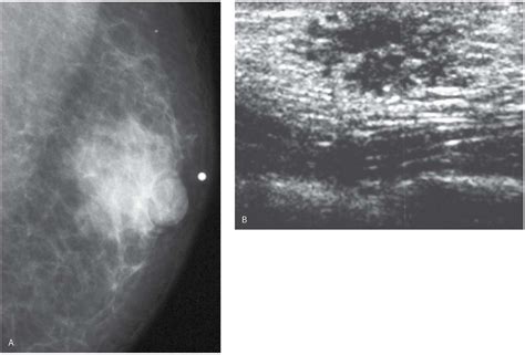 The Male Breast Radiology Key