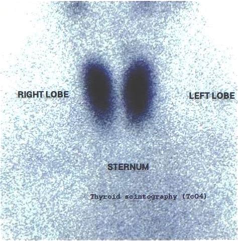 Thyroid Scintigraphy With 5 Mci Tco 4 Normal Uptake Of The Tracer In Download Scientific