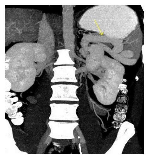 A Cirrhotic Patient With Retrogastric Varices And A Splenorenal Shunt