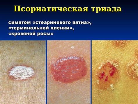 Псориаз диагностика и лечение у опытного дерматолога в Москве
