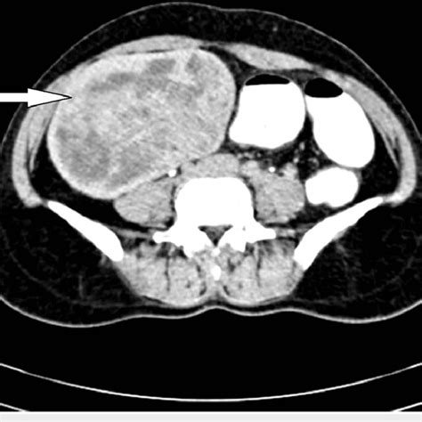 A Large 12 X 10 Cm Heterogeneous Mass White Arrow With Necrotic Areas