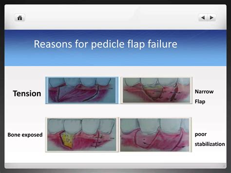 Root Coverage Procedures Pptx