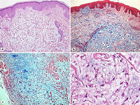 Scleromyxedema Collagen Fibers In The Dermis Are Widely Separated By