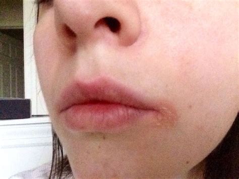 Angular Cheilitis Scars