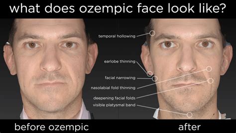 Signs Of Ozempic Face According To A Plastic Surgeon R Ozempicface