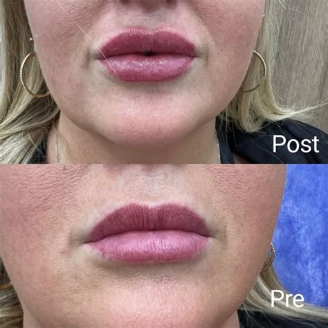 Lip Augmentation In Hurghada Book Now Nadara Center