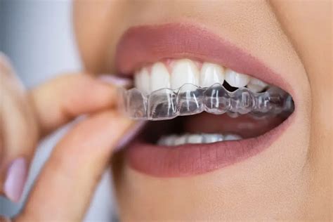 Invisible Aligners Aligners In Hyderabad Hyderabad Smiles