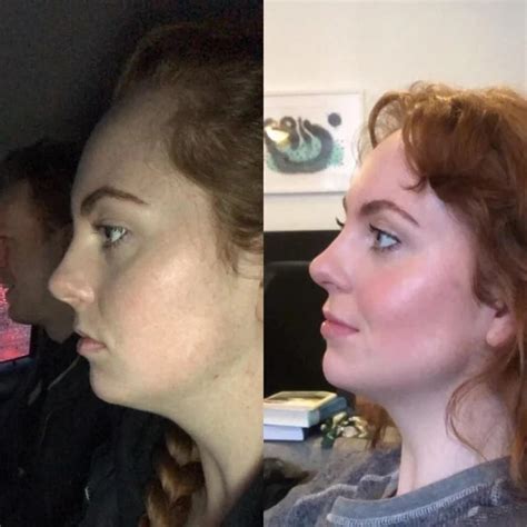 Mewing Before And After Transforming Your Face With Proper Tongue