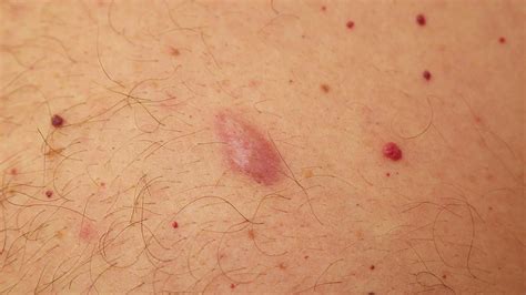 13 Home Remedies To Reduce Armpit Lumps Prevent Wrink