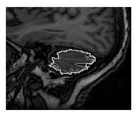 Correction Of Atlas Based Contours Dotted Line Original Contours Download Scientific Diagram