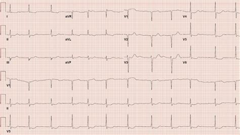 Regularized Atrial Fibrillation The American Journal Of Medicine