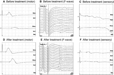 Figure2left Median Nerve Conduction Study Findings Before A C And