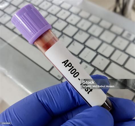 Blood Sample For Ap100 Test Total Hemolytic Complement To Measurement
