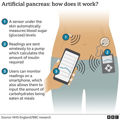 Diabetes Patients To Be Offered Artificial Pancreas Technology Bbc News