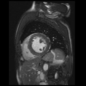 Compressed Sensing CS MRI