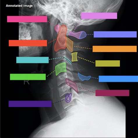 Diagram Of Img1 Cervical Spine Label The Radiographic Anatomy Quizlet