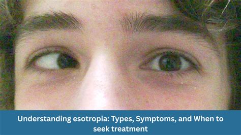 Understanding Esotropia Types Symptoms And Treatment