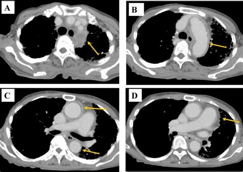 Rheumatoid Arthritis Associated Aortitis A Case Report And Literature