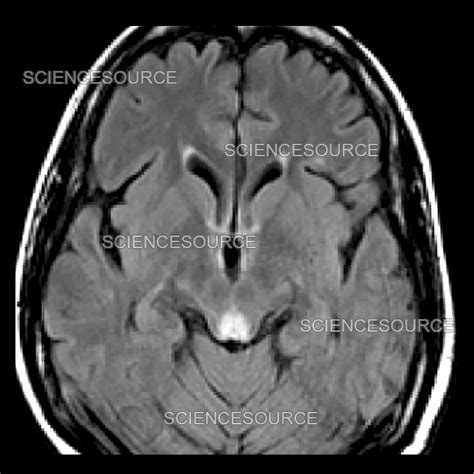 Wernickes Encephalopathy