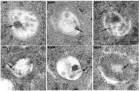 Synuclein Is Seen Inside Vesicles With Autophagic Morphology