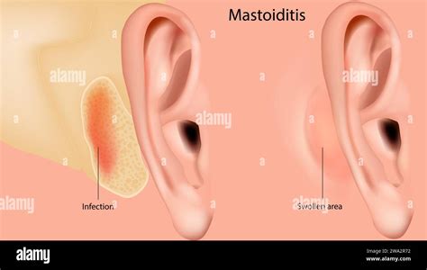 Mastoiditis Inflammation Of The Mucosal Lining Of The Mastoid Antrum