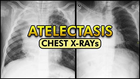 Atelectasis Chest X Ray Signs Youtube