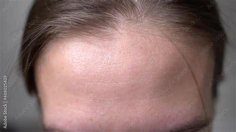 A Womans Forehead Wrinkles The Woman Is Surprised By Raising Her